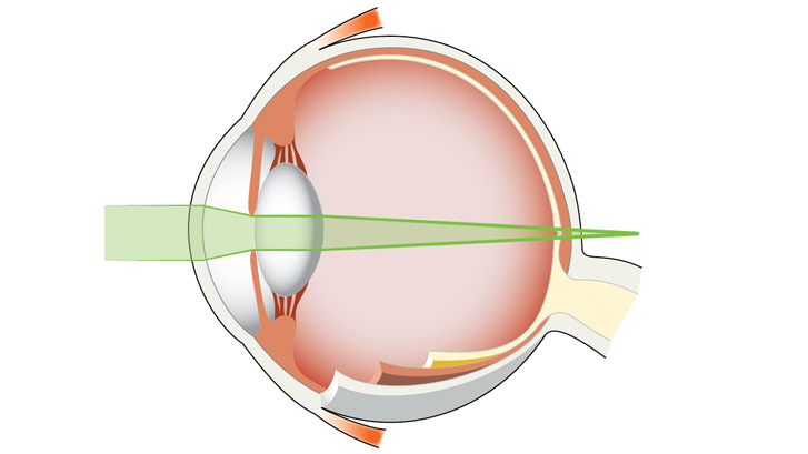 Verziendheid - Memira by Bergman Clinics