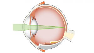 Verziendheid - Memira by Bergman Clinics
