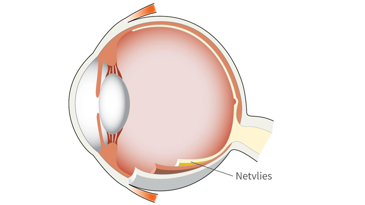 Het netvlies - Memira by Bergman Clinics